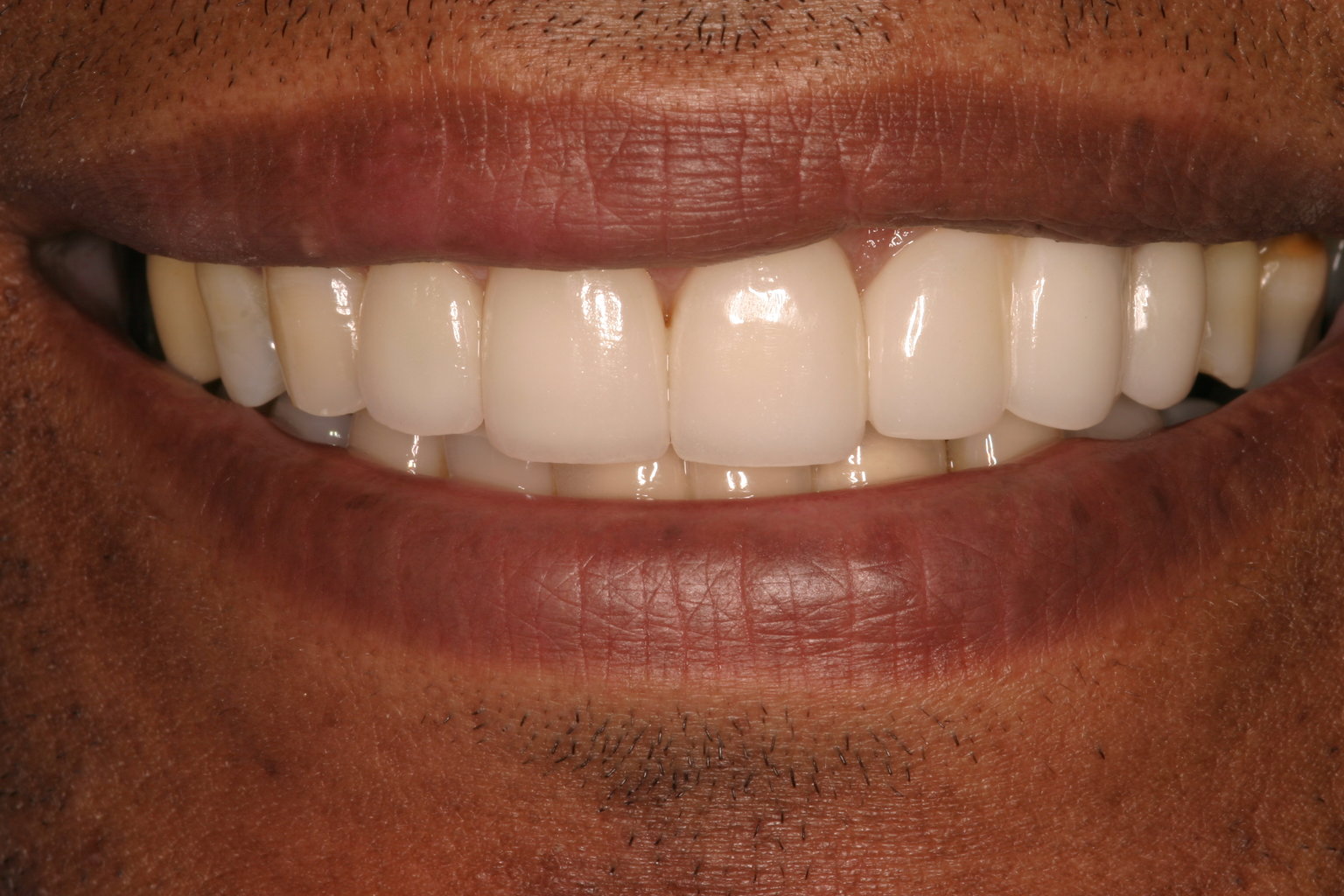 See a Radiant New Smile Today with Digital Smile Design in Massapequa ...